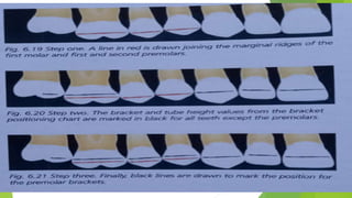 bracket positioning in orthodontics.pptx