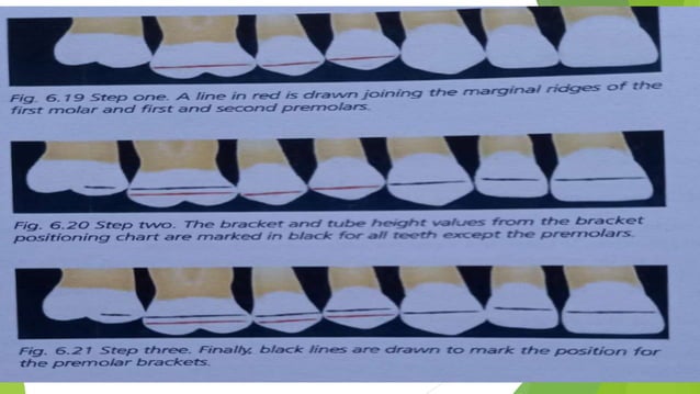 bracket positioning in orthodontics.pptx