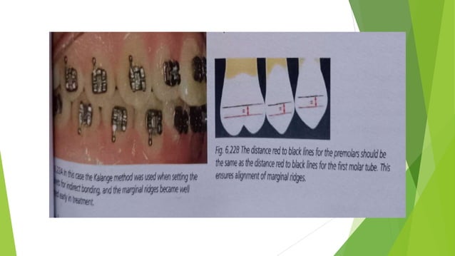 bracket positioning in orthodontics.pptx