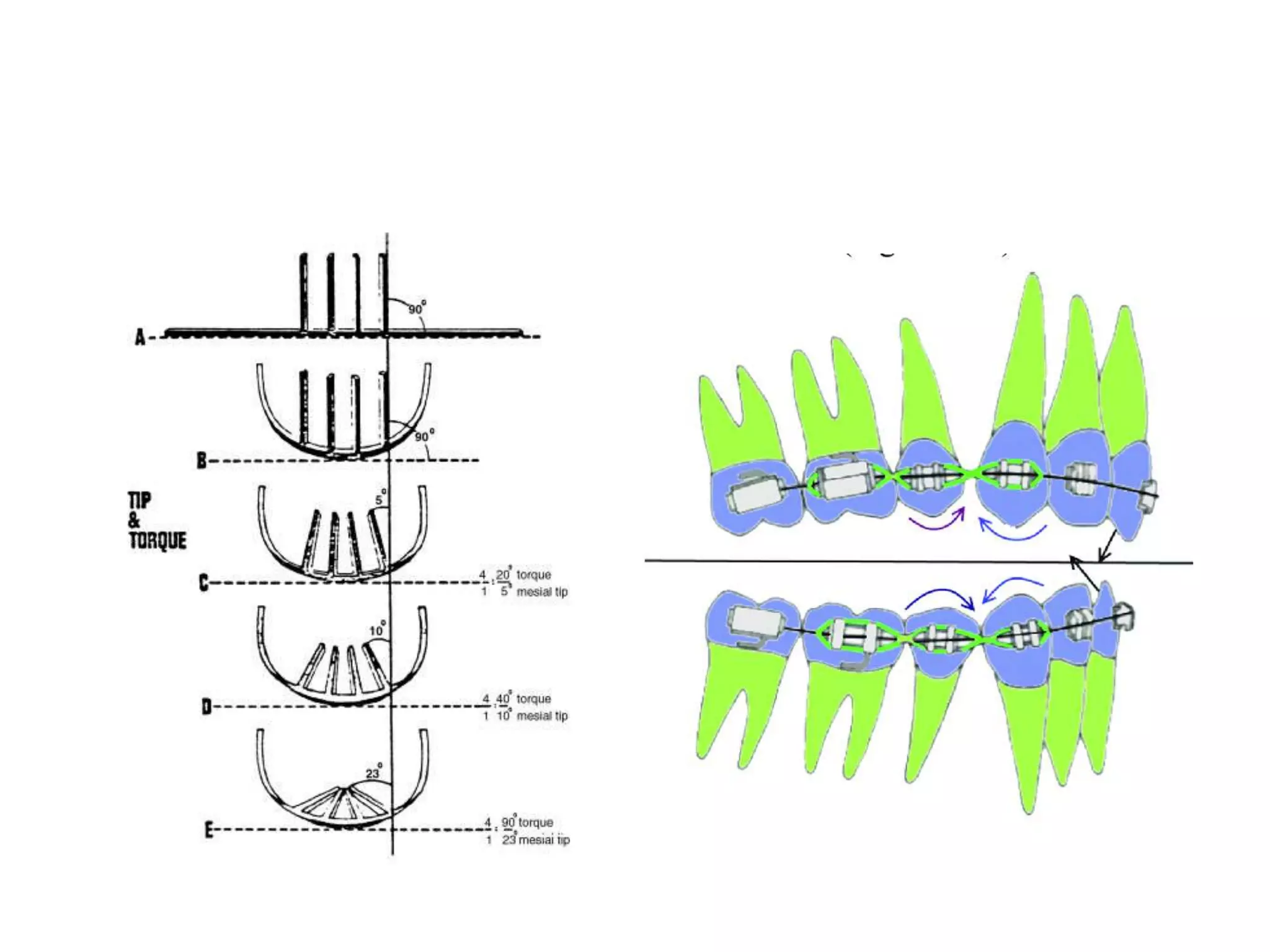 Bracket prescription(Orthodontics) | PPTX