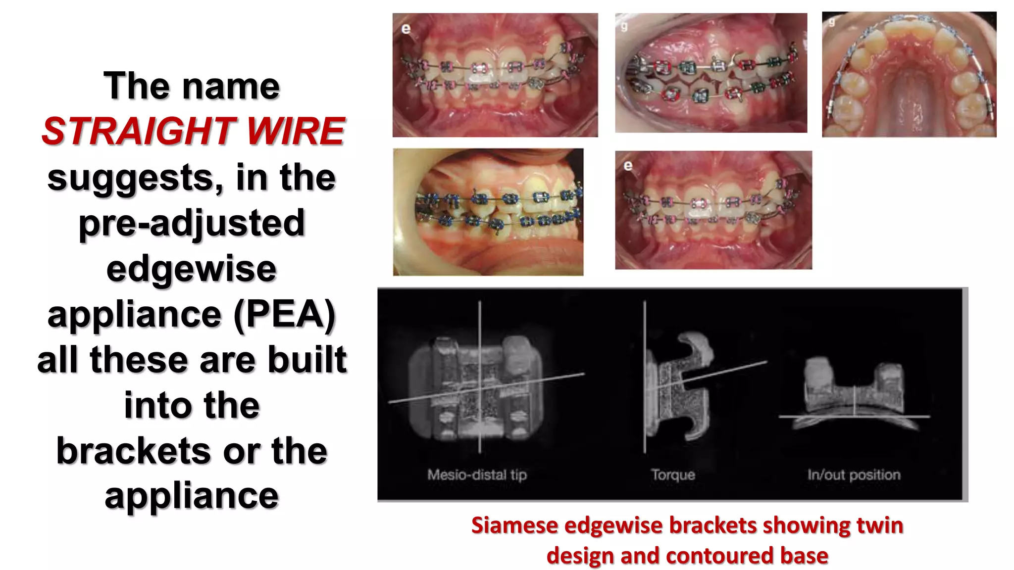 orthodontic bracket prescription 1 | PPTX