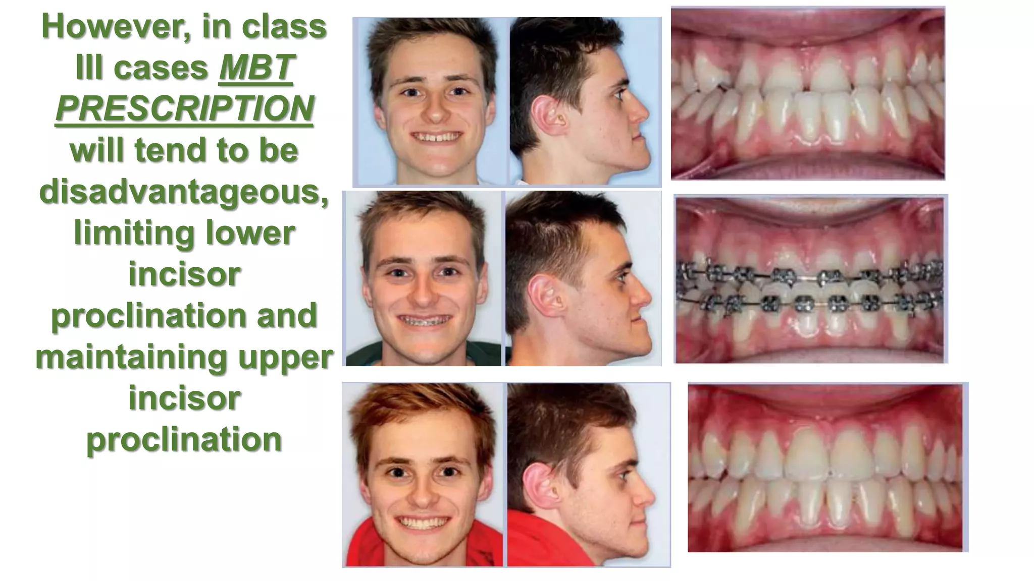 orthodontic bracket prescription 1 | PPTX