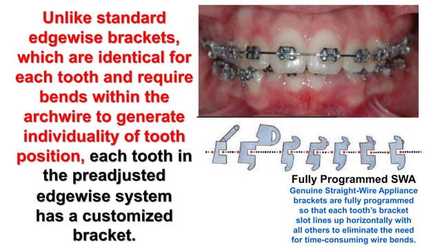 orthodontic bracket prescription 1 | PPTX