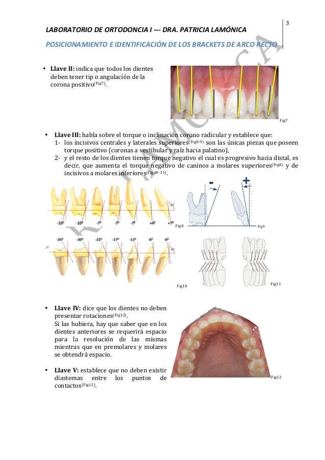 Posicionamiento e identificación de Brackets arco recto