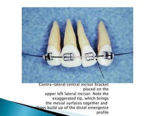 Brackets’ modification | PPTX