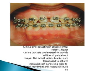 Brackets’ modification | PPTX