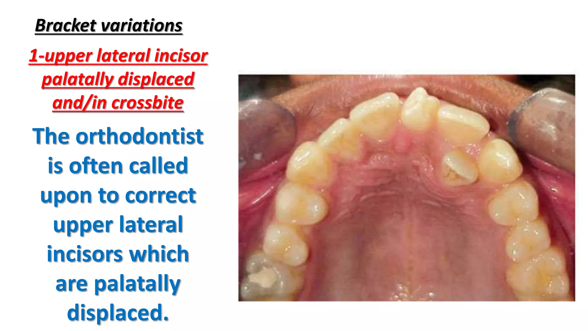 orthodontic Bracket variations | PPTX