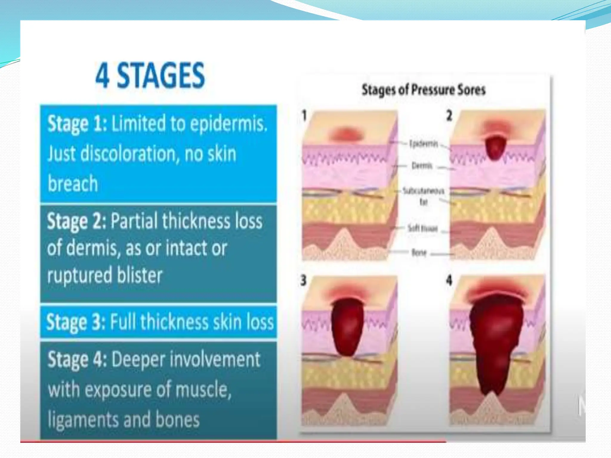 Definitions Pressure ulcers: Nursing home providers were asked the ...