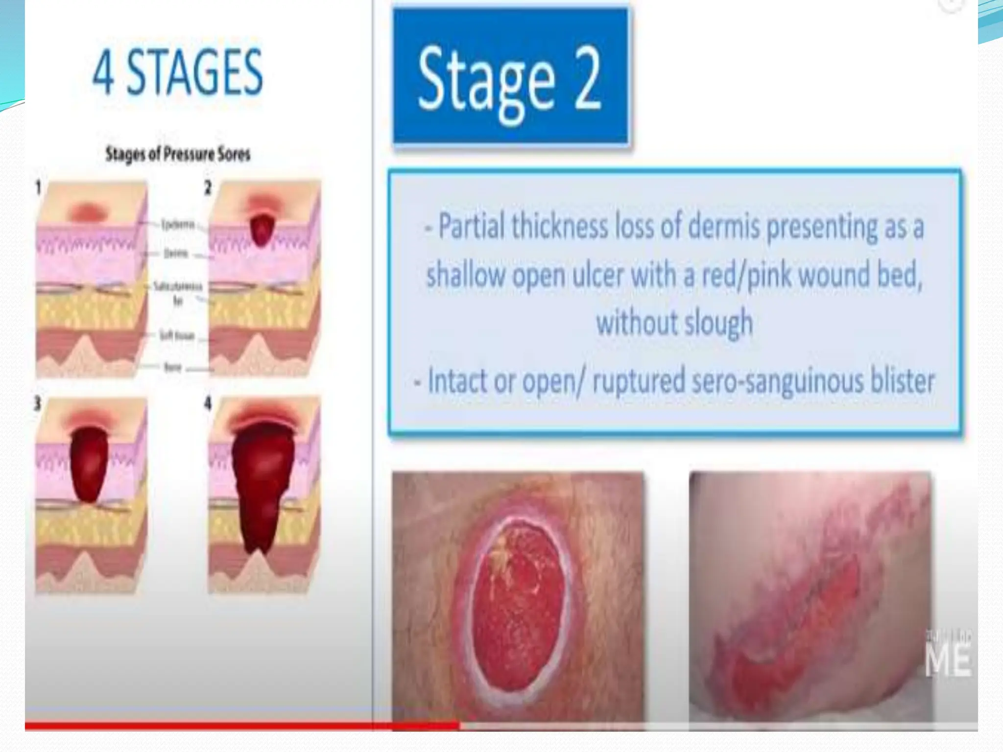 Definitions Pressure ulcers: Nursing home providers were asked the ...