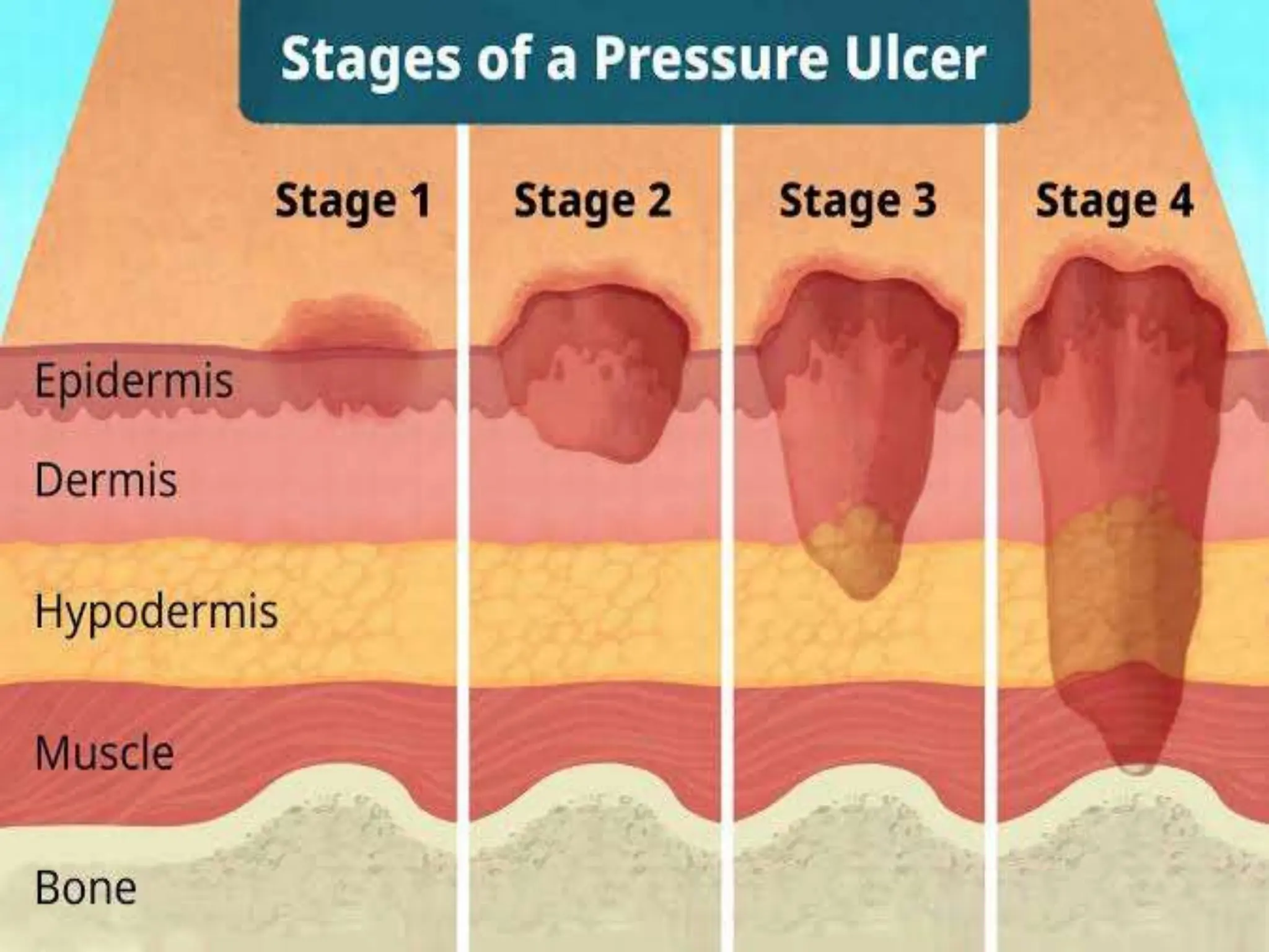 Definitions Pressure ulcers: Nursing home providers were asked the ...