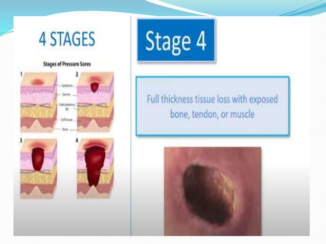 Definitions Pressure ulcers: Nursing home providers were asked the ...