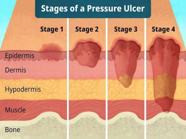 Definitions Pressure ulcers: Nursing home providers were asked the ...