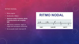 Bradiarritmias.pptx