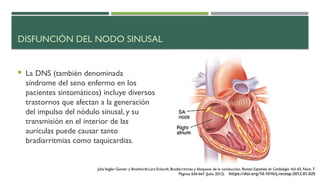 MANEJO DE BRADIARRITMIAS EN MEDICINA INTERNA | PPTX