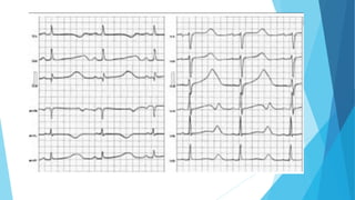 BRADICARDIA SINUSAL Y BLOQUEO SINOAURICULAR.pptx