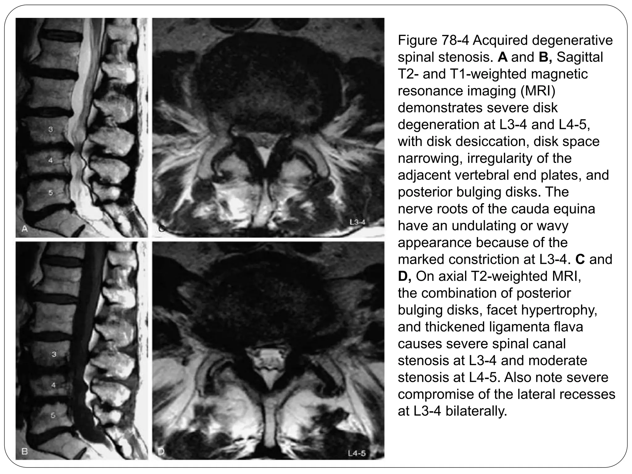 lower back and leg pain approaches | PPTX