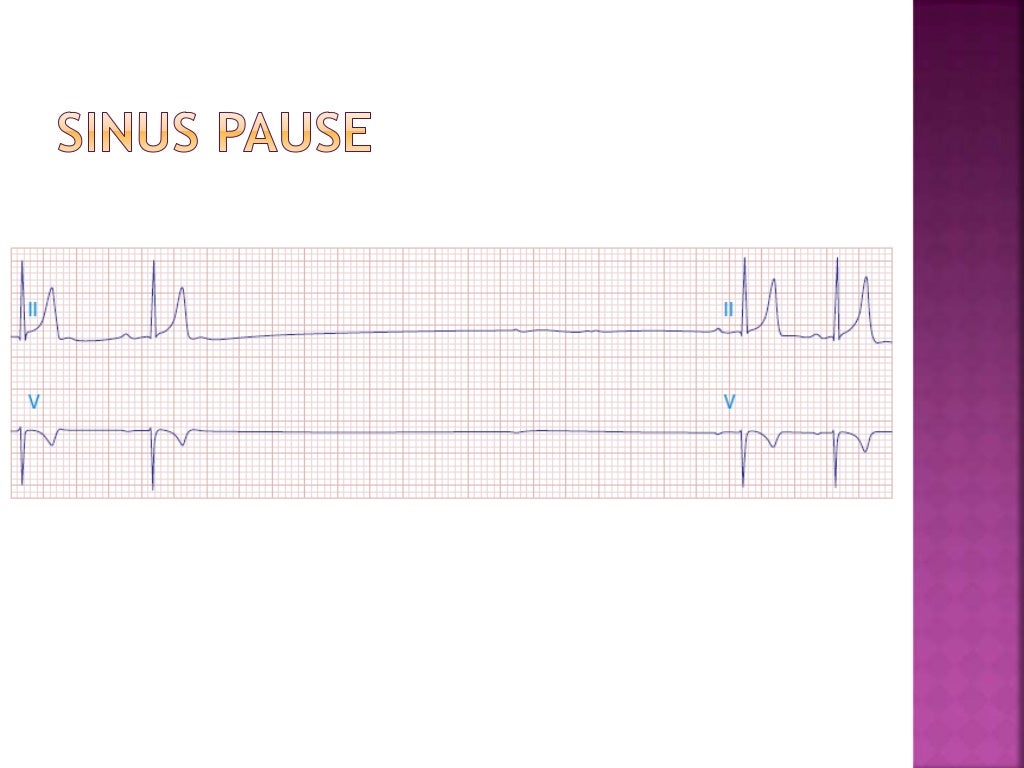 Bradyarrhythmias