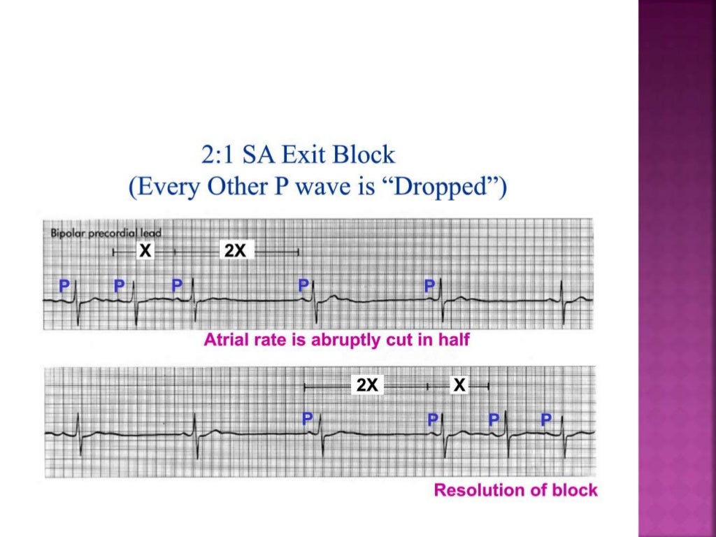 Bradyarrhythmias