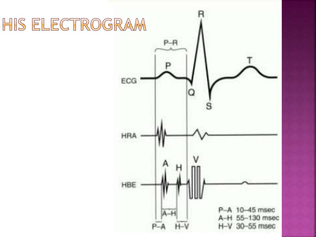 Bradyarrhythmias