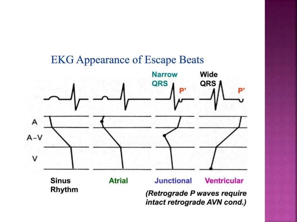 Bradyarrhythmias