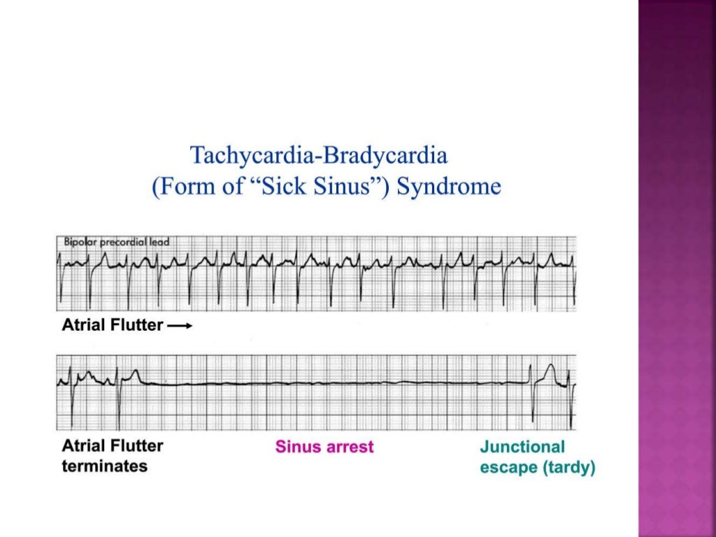 Bradyarrhythmias
