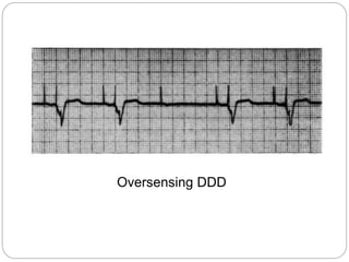 Bradyarrhythmias and malfunctioning pacemakers | PPTX