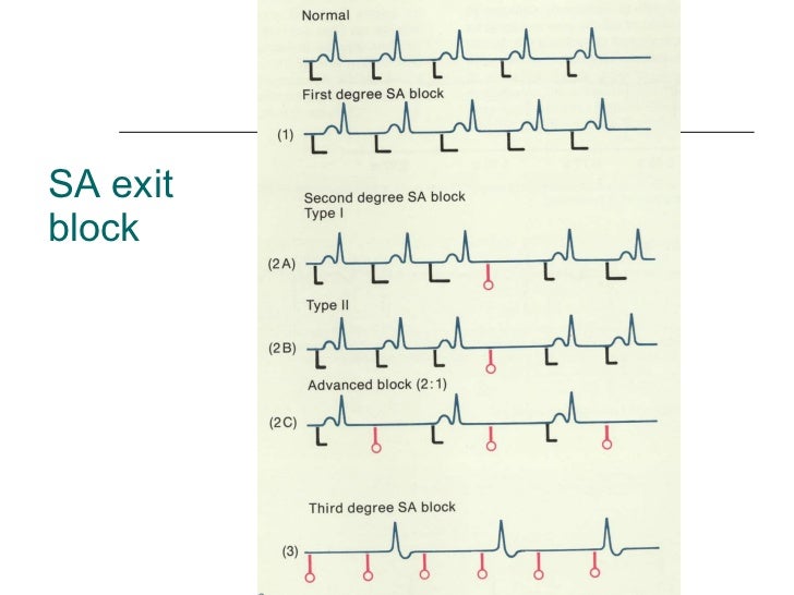Bradyarrhythmias and pacemaker choice