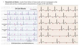 BRADYARRHYTHMIAS; Disorders of SA node , AV node and Intraventricular ...