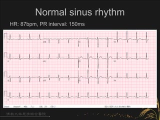 Arrhythmia :ECG-Bradycardia_20120909_中區 | PPT