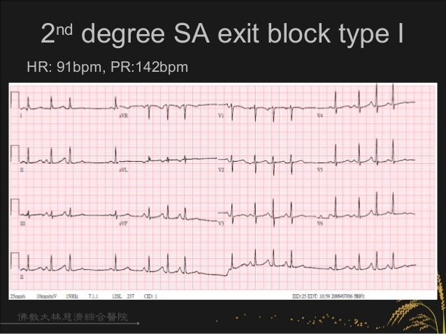 Arrhythmia :ECG-Bradycardia_20120909_中區