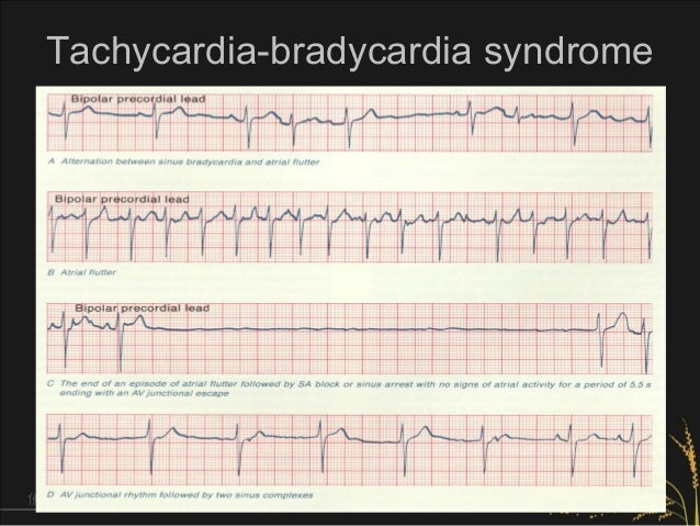 Arrhythmia :ECG-Bradycardia_20120909_中區