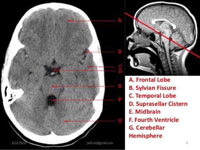 Sylvian Fissure Mri