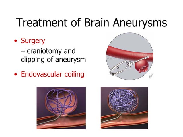 Brain Aneurysms & AV Malformations | PPT | Brain and Nervous System Disorders | Diseases and ...