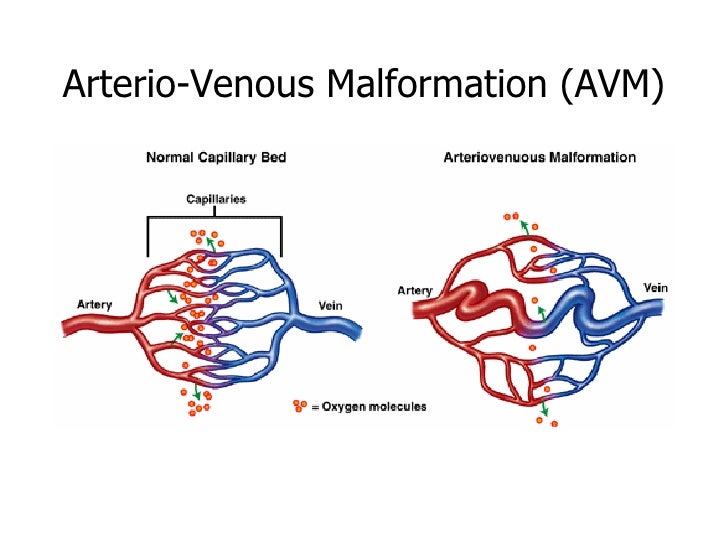 Brain Aneurysms & AV Malformations