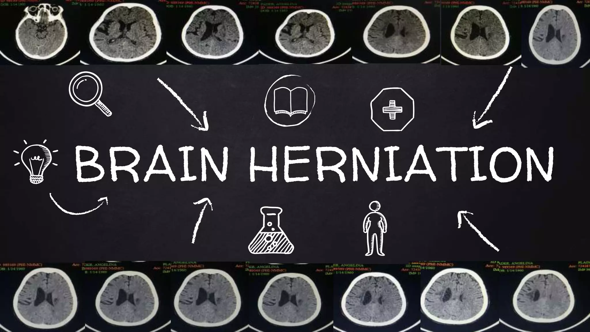 Brain herniation | PPT