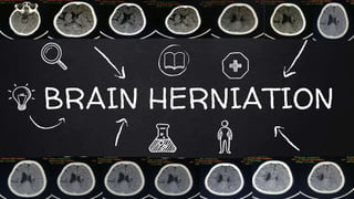 Brain herniation | PPT