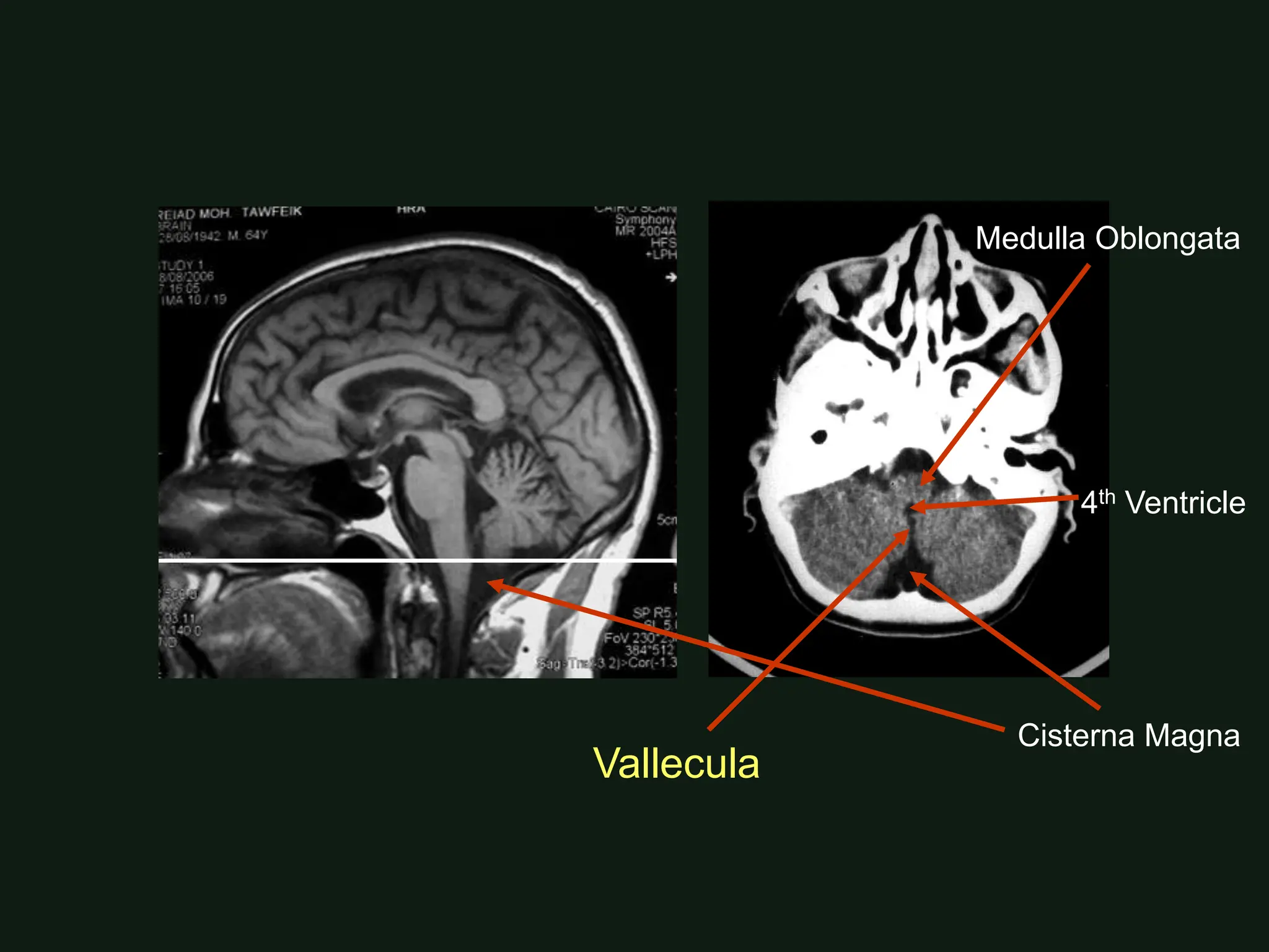 Normal brain imaging in CT and MRI for medical students | PDF