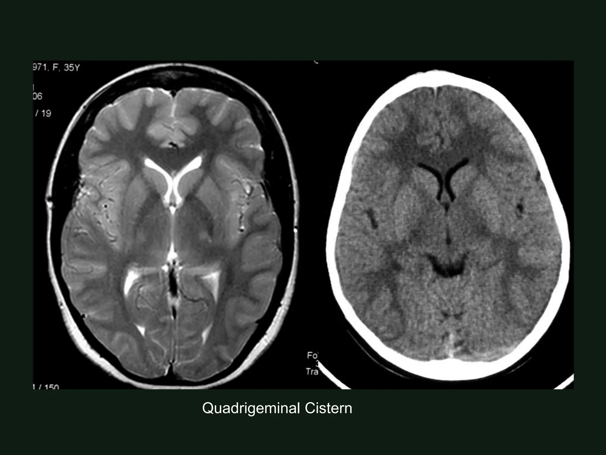 Normal brain imaging in CT and MRI for medical students | PDF
