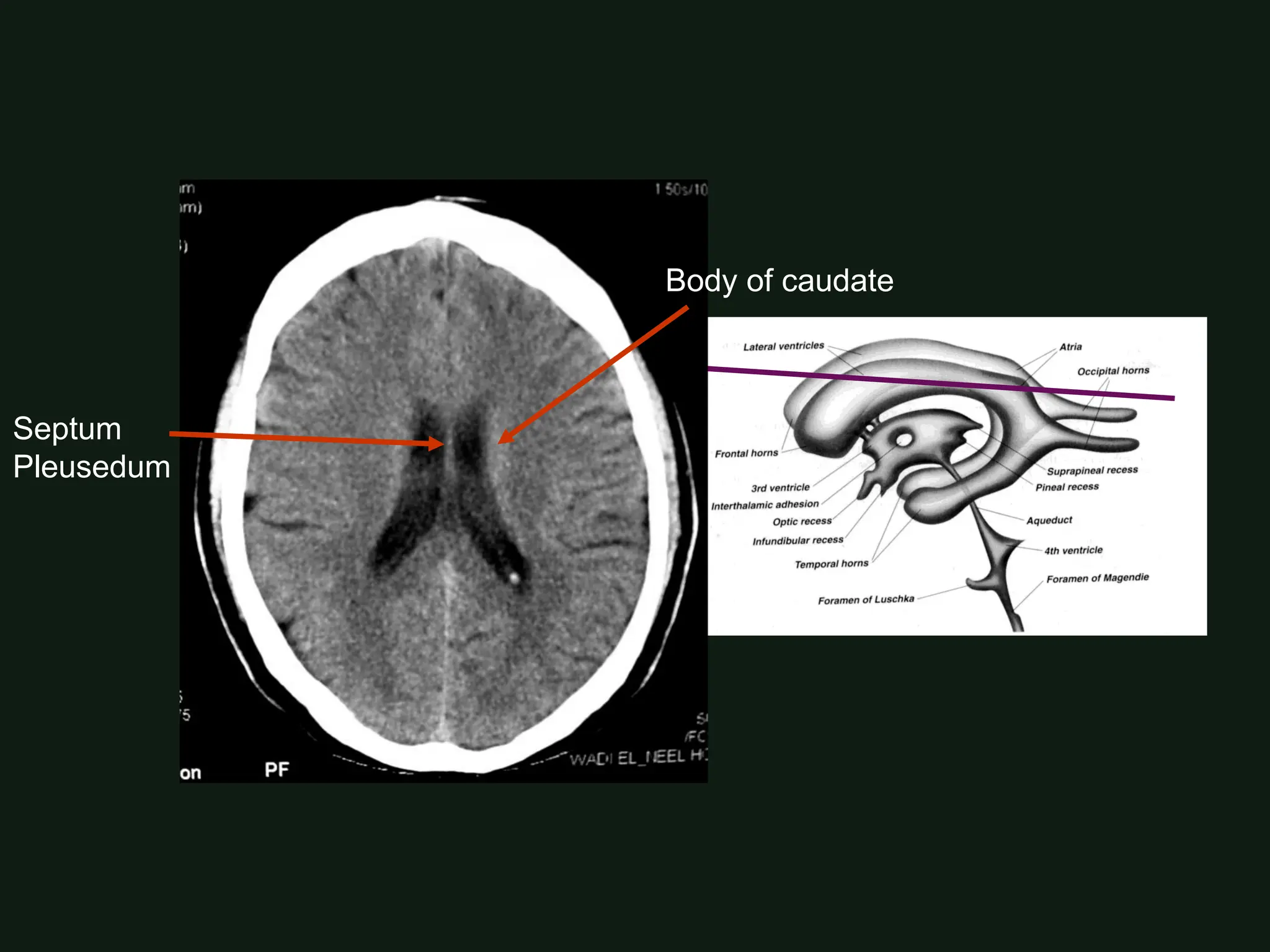 Normal brain imaging in CT and MRI for medical students | PDF