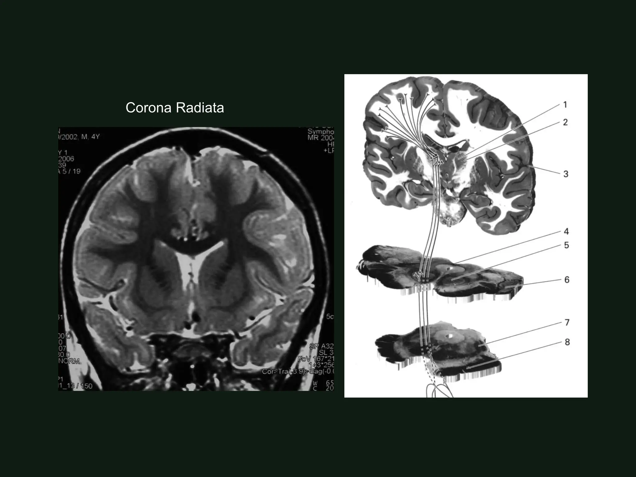 Normal brain imaging in CT and MRI for medical students | PPT