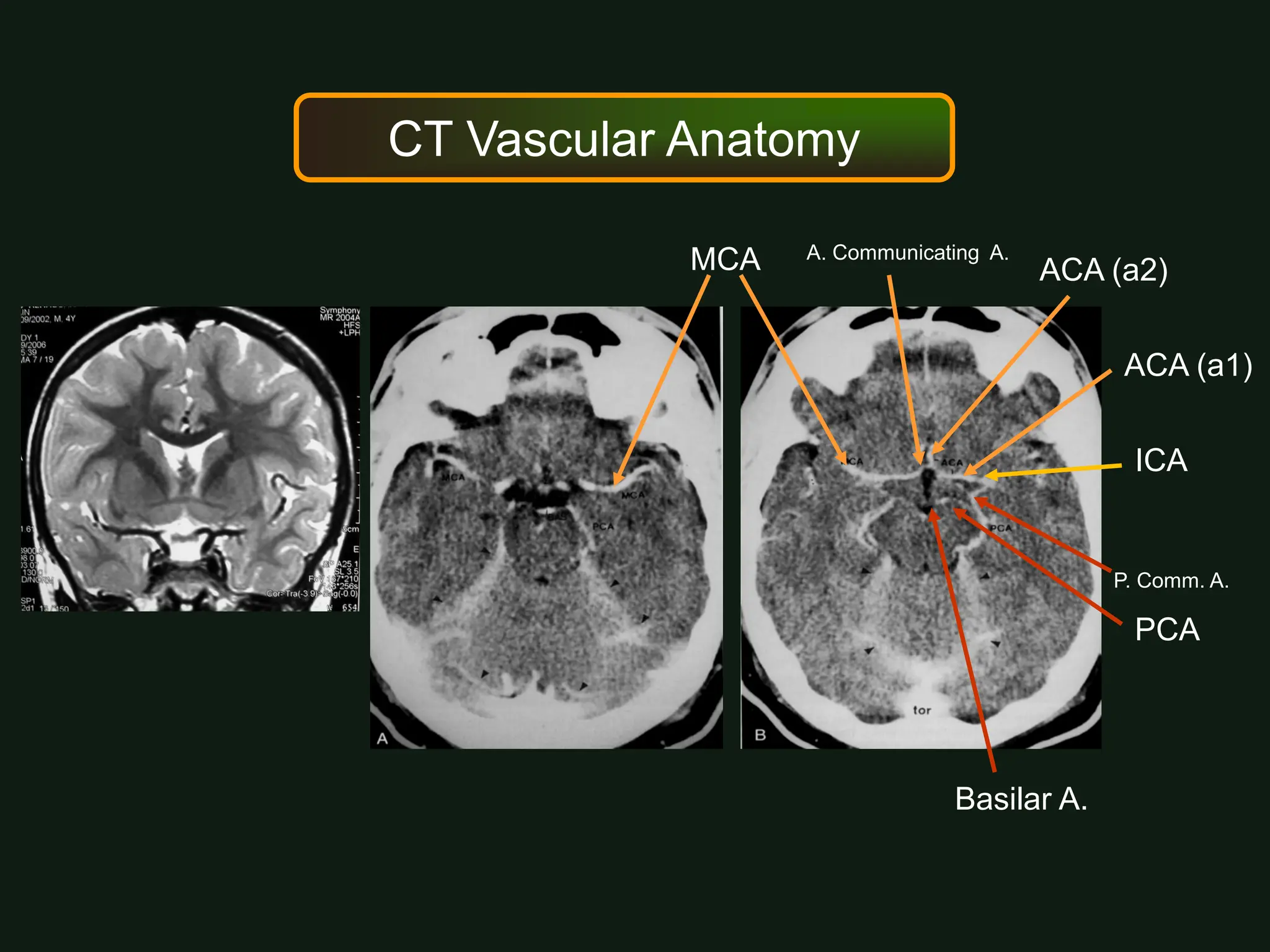 Normal brain imaging in CT and MRI for medical students | PDF