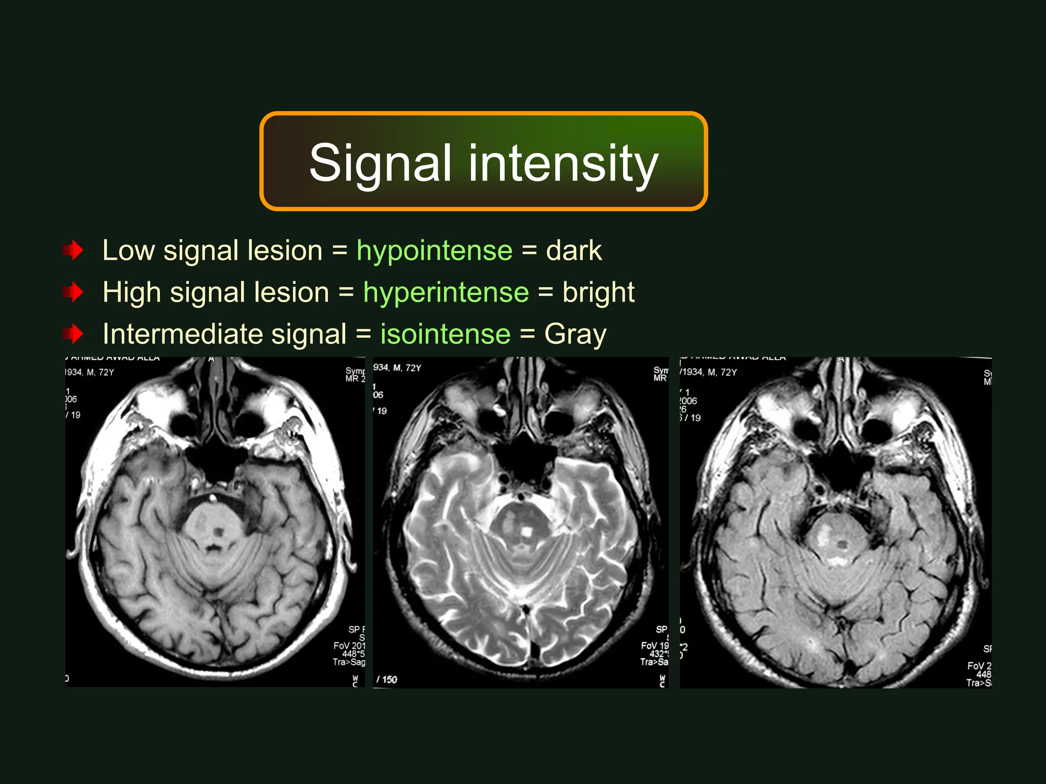Normal brain imaging in CT and MRI for medical students | PDF