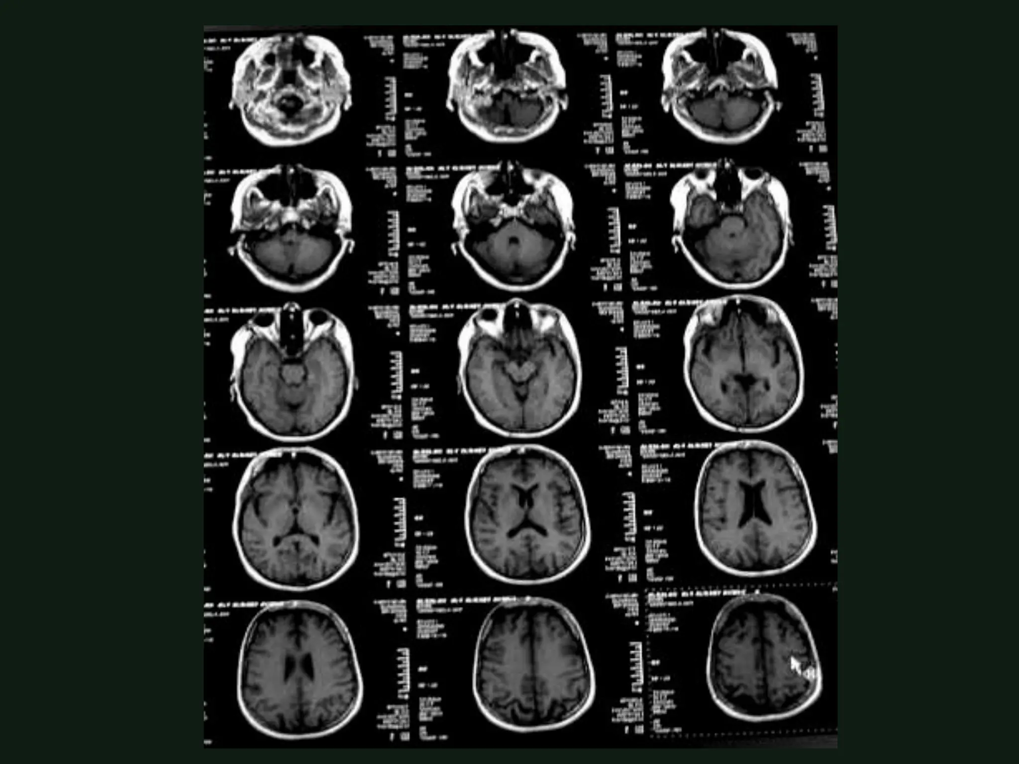 Normal brain imaging in CT and MRI for medical students | PDF