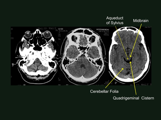 Normal brain imaging in CT and MRI for medical students | PDF | Brain ...