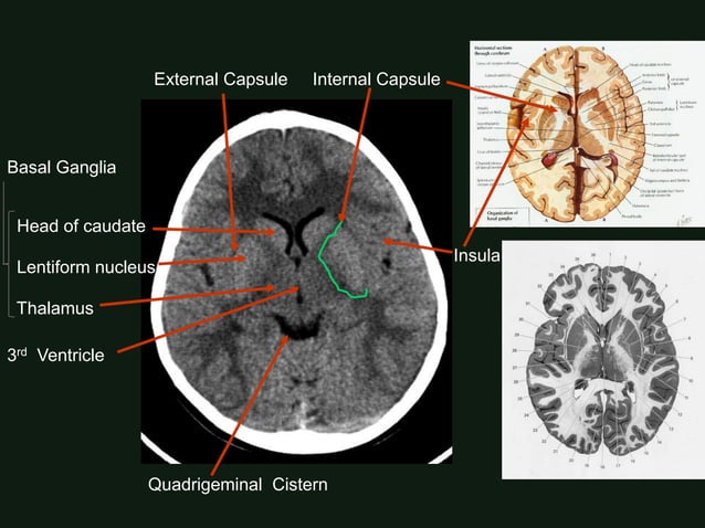 Normal brain imaging in CT and MRI for medical students | PDF | Brain ...