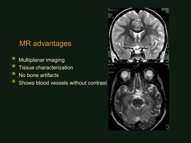 Normal brain imaging in CT and MRI for medical students | PDF | Brain ...