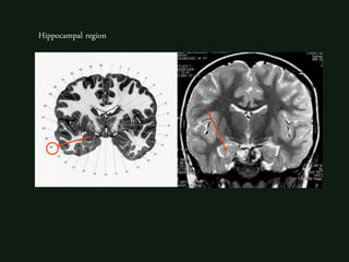 Normal brain imaging in CT and MRI for medical students | PDF
