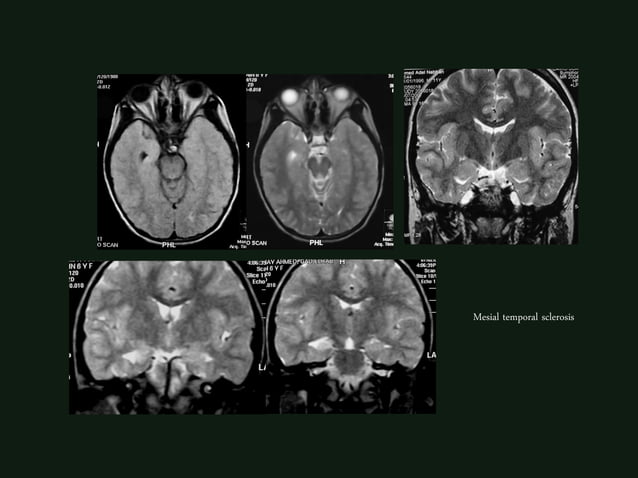 Normal brain imaging in CT and MRI for medical students | PDF | Brain ...