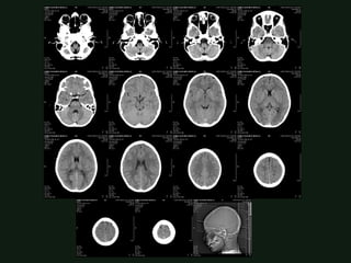 Normal brain imaging in CT and MRI for medical students | PDF
