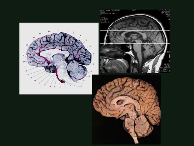 Normal brain imaging in CT and MRI for medical students | PDF | Brain ...